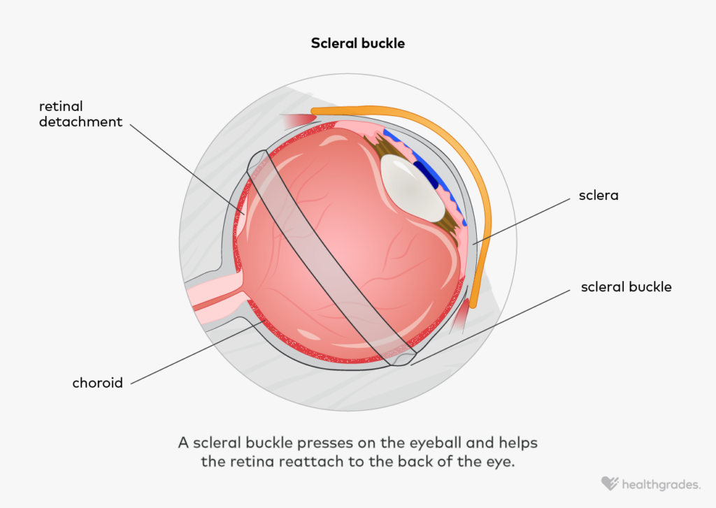 Scleral Buckle: Purpose, Procedure, and Recovery